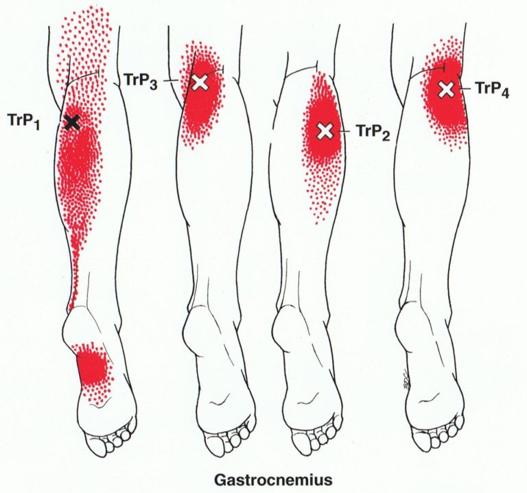 Stijve kuit - Oefentherapie Eindhoven