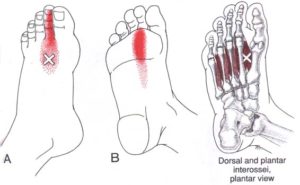 Wreef pijnklachten - Oefentherapie Eindhoven