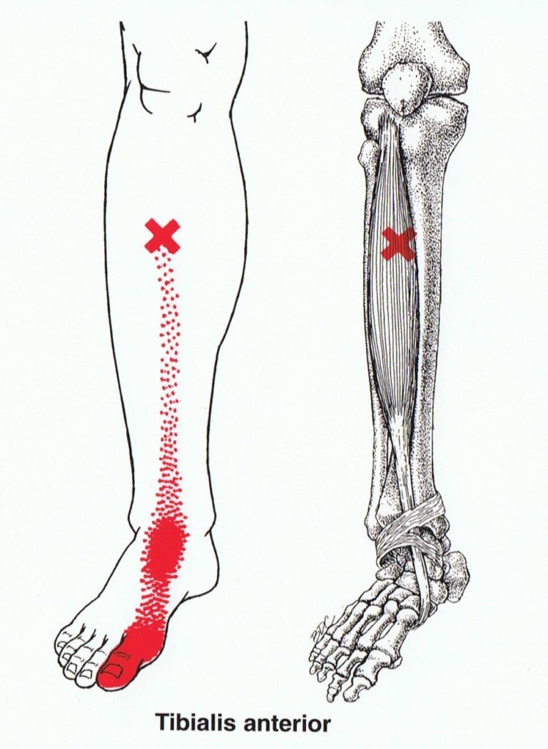 Shin splint - Oefentherapie Eindhoven