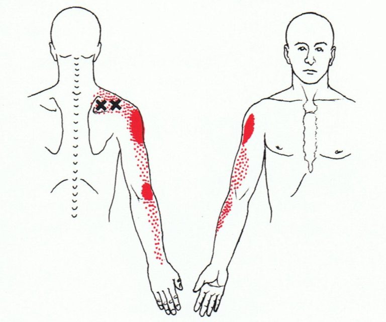 Onderarm pijnklachten - Oefentherapie Eindhoven