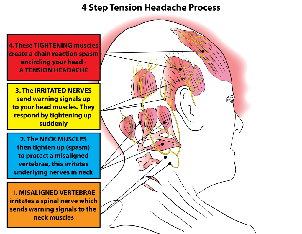 Tension type headache - Oefentherapie Eindhoven